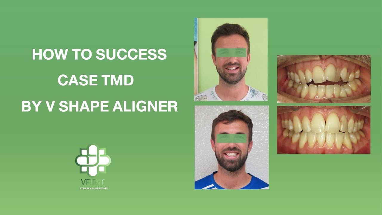 How to success case TMD by V shape aligner | V First Dental