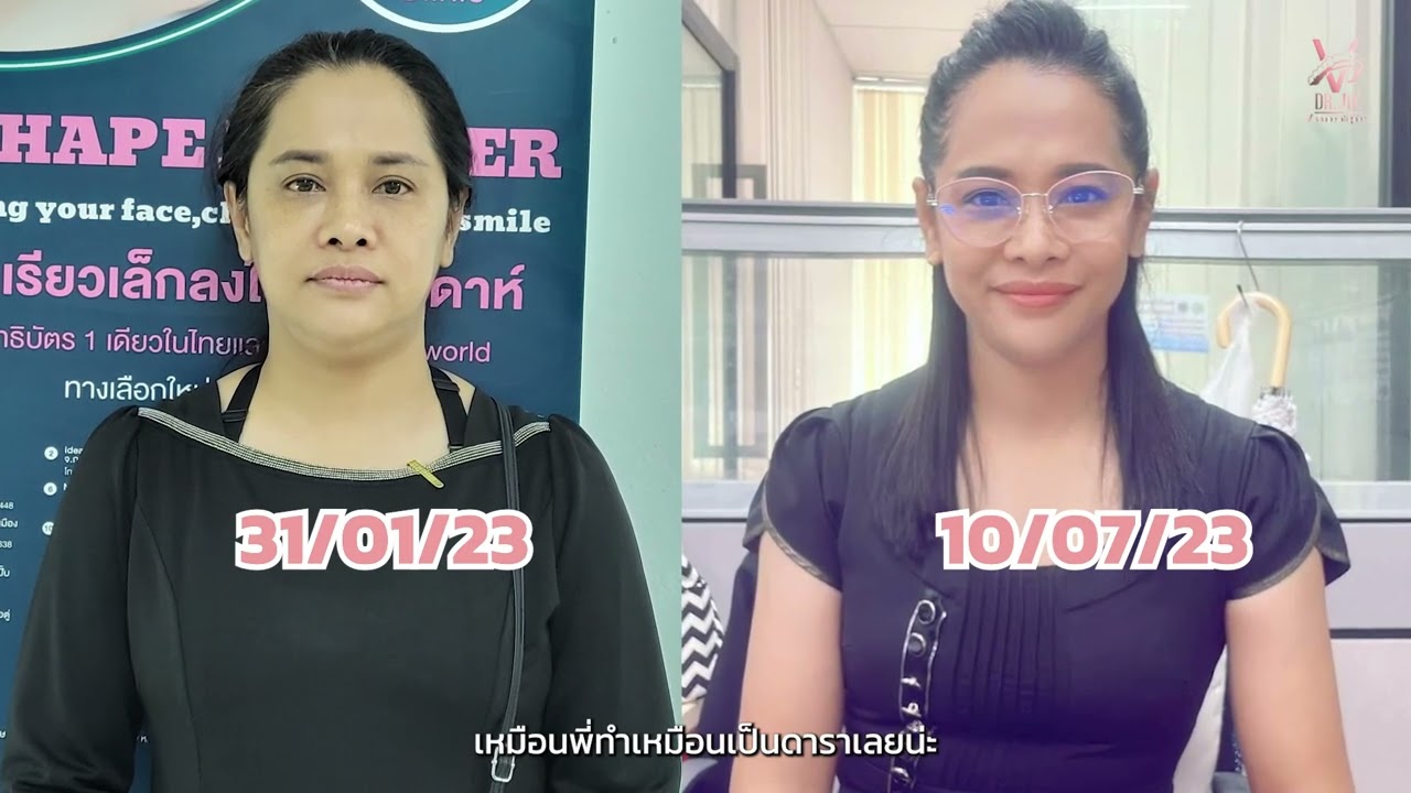 เพื่อนเดินผ่านจำไม่ได้ บอกว่าไปทำอะไรมาสวยขึ้น vshapealigner ช่วยให้ชีวิตดีขึ้นจริง ! | V First ...